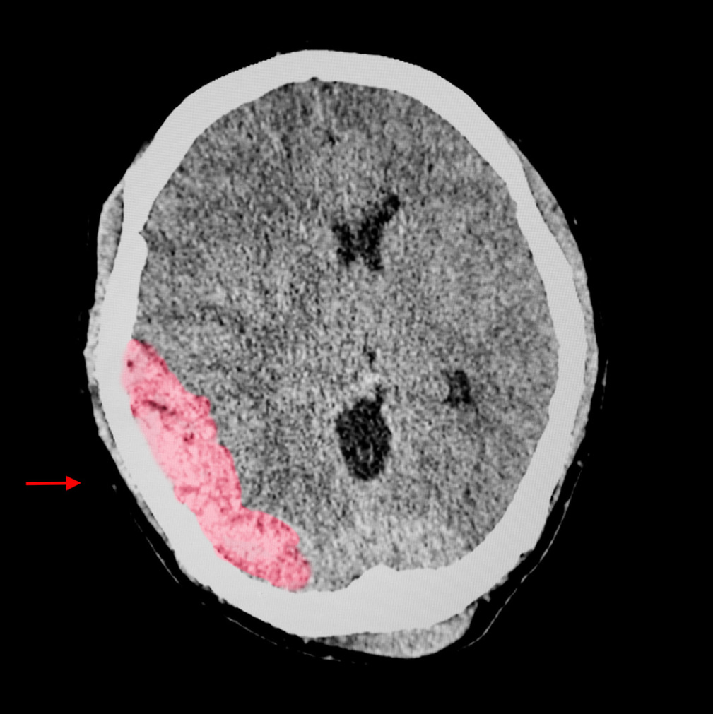 Average Settlement for Traumatic Brain Injury (TBI) from Car Accident ...